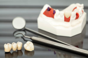 What to Do if You Have a Chipped or Broken Crown | Absolute Dental