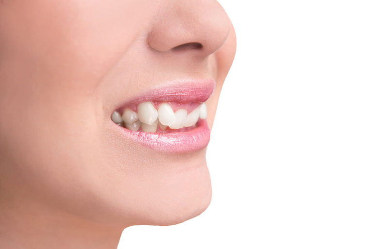 Overbite Causes & Treatments | Absolute Dental