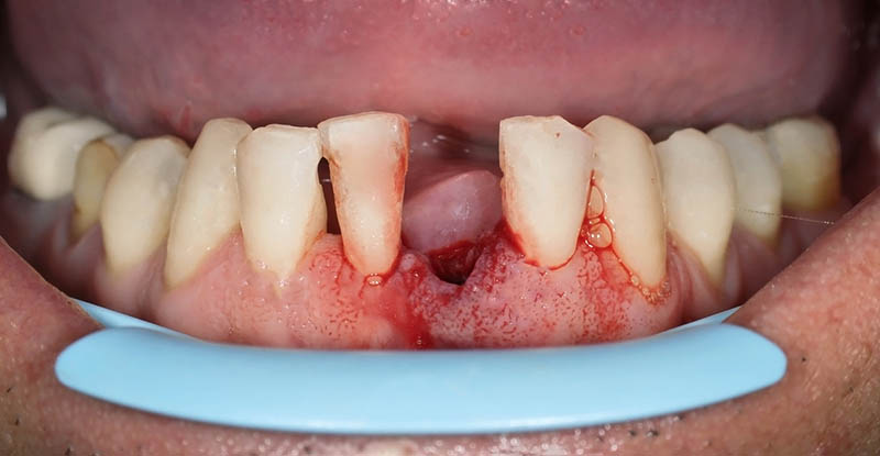 Emergency Dentists in Reno | Absolute Dental