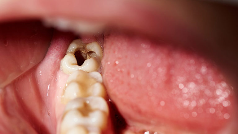 Causes and Treatments for a Dead Tooth | Absolute Dental