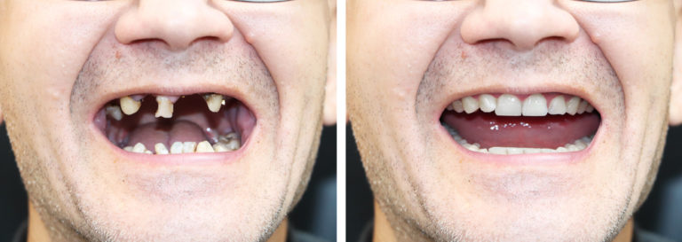 Meth Mouth: Why Meth Destroys Your Mouth | Absolute Dental