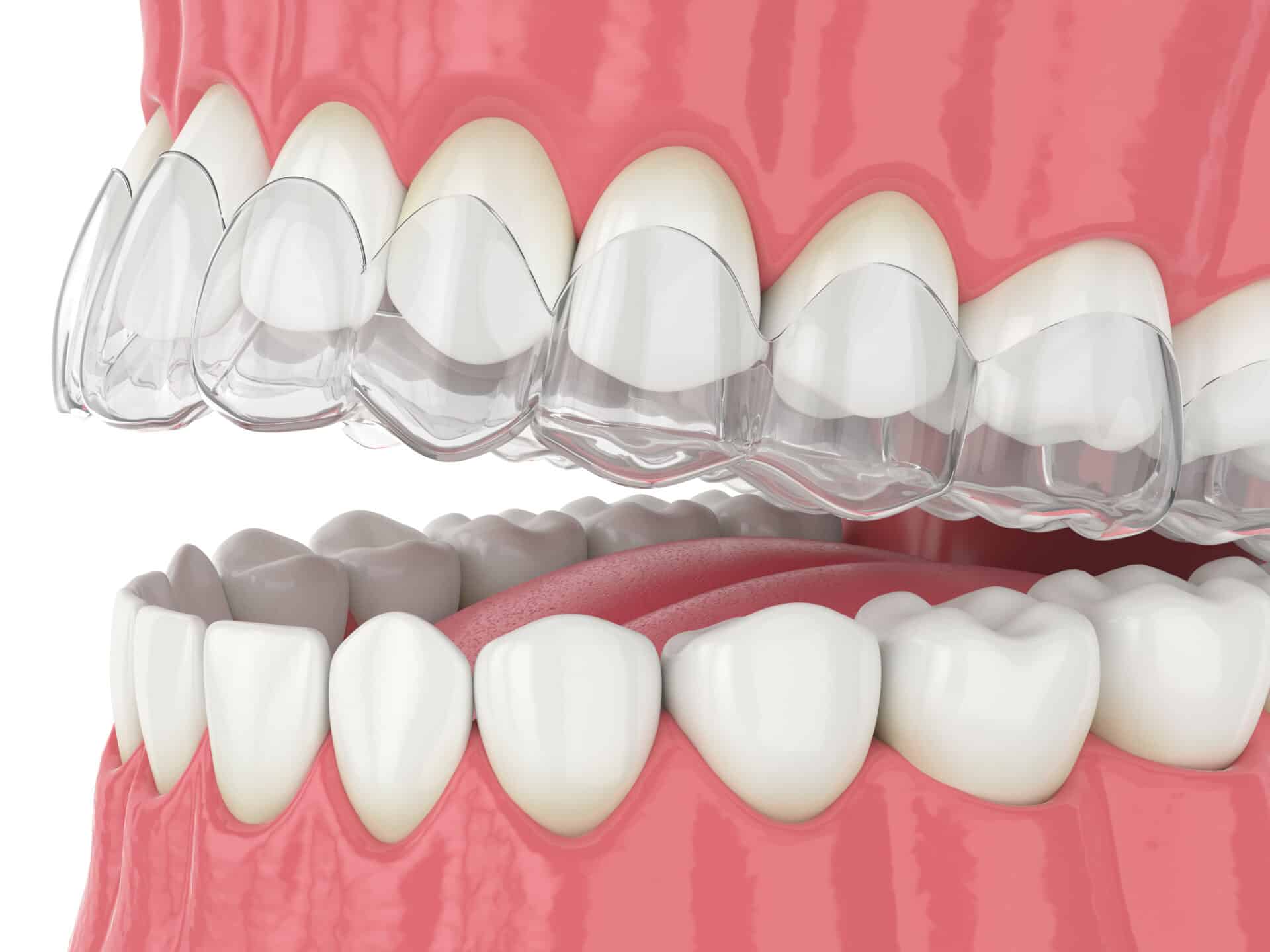 The Pros and Cons of Essix Retainers | Absolute Dental