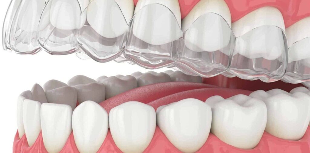 Fixed & Permanent Retainers in Las Vegas | Absolute Dental