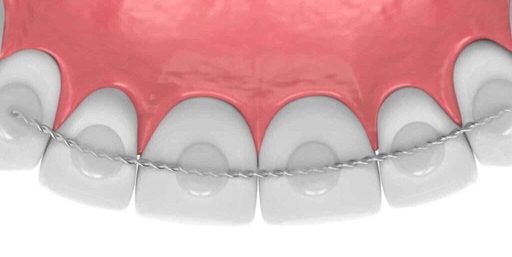 Fixed & Permanent Retainers in Las Vegas | Absolute Dental