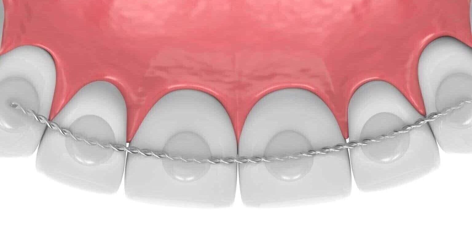 Fixed & Permanent Retainers in Las Vegas | Absolute Dental