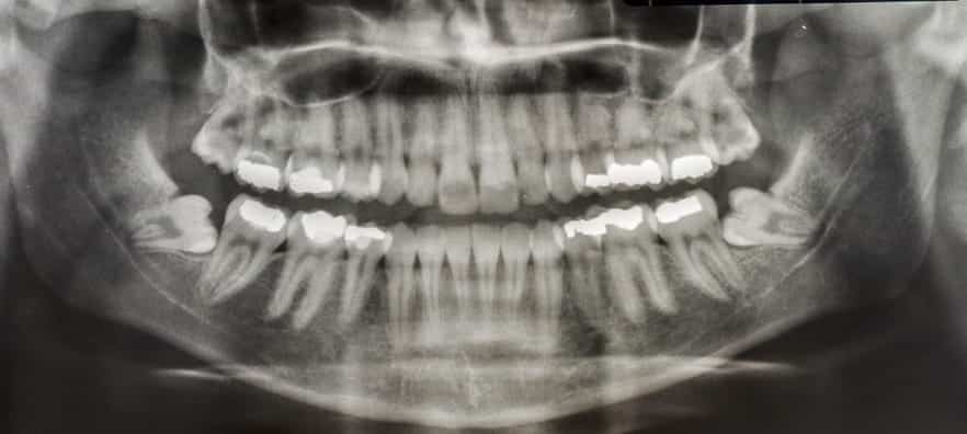 Recovery After Wisdom Teeth Removal – What To Expect