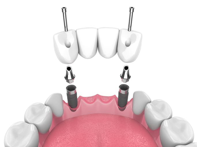 Traditional Dental Bridges | Best Types and Top Benefits