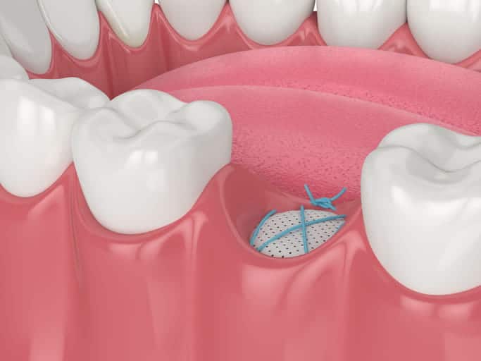 Oral Surgery for Bone and Tooth Loss | Absolute Dental